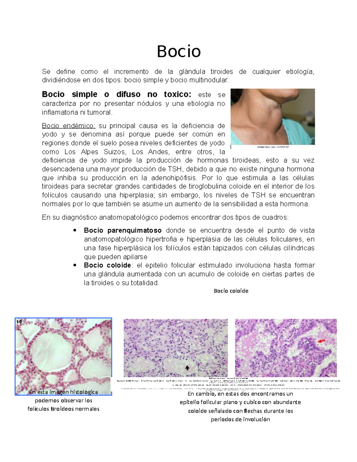 Histopatología del Bocio enfermedades tiroideas - Bocio Se define como ...