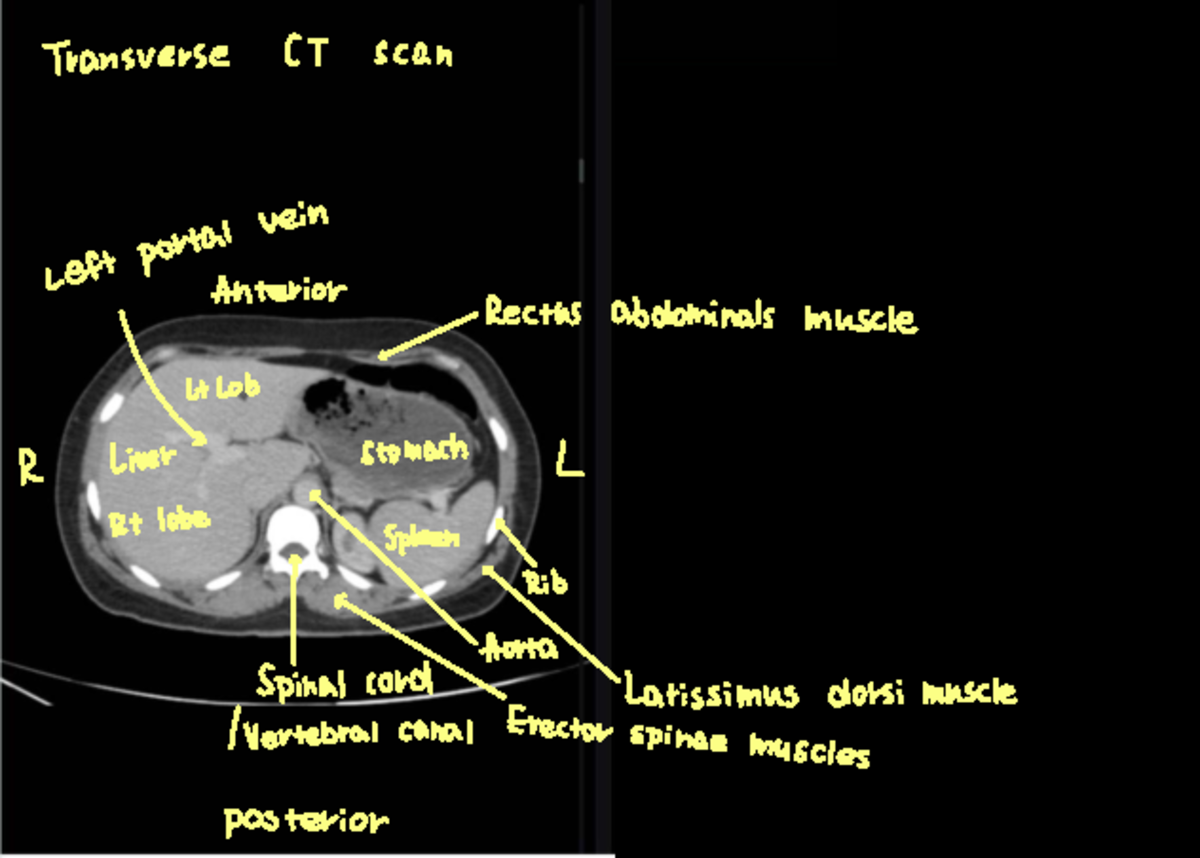 DEV2022 - CT label - DEV2022 - Transverse CT scan Liver spleen Left ...