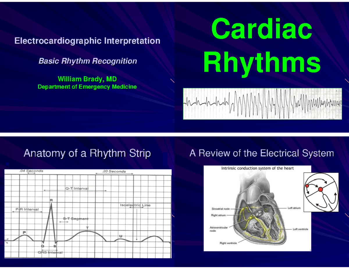 Basic Rhythm Recognition - Electrocardiographic Interpretation Basic ...