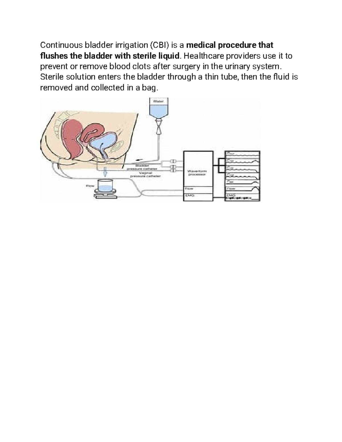 Continuous Bladder Irrigation Tubing