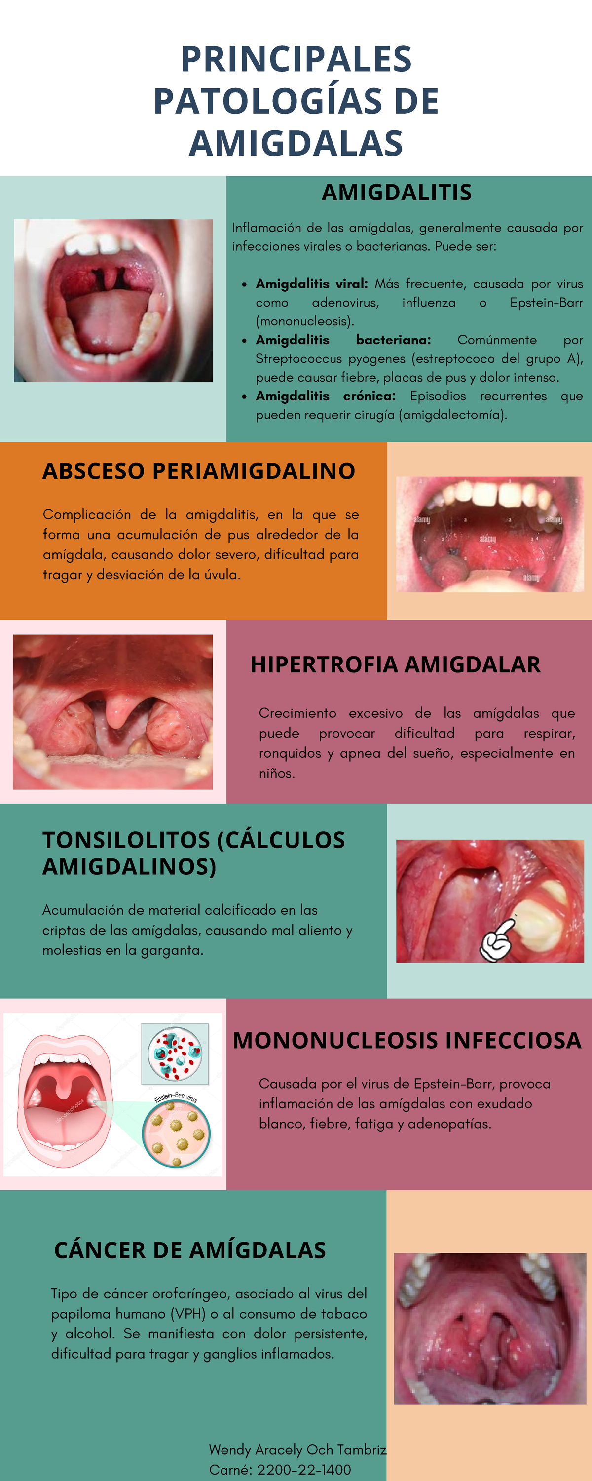 Principales patologías de amigdalas - AMIGDALITIS Inflamación de las ...
