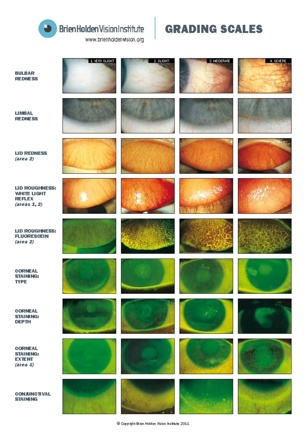 Cclru Grading Scales: Bulbar & Limbal Redness Assessment - Studocu