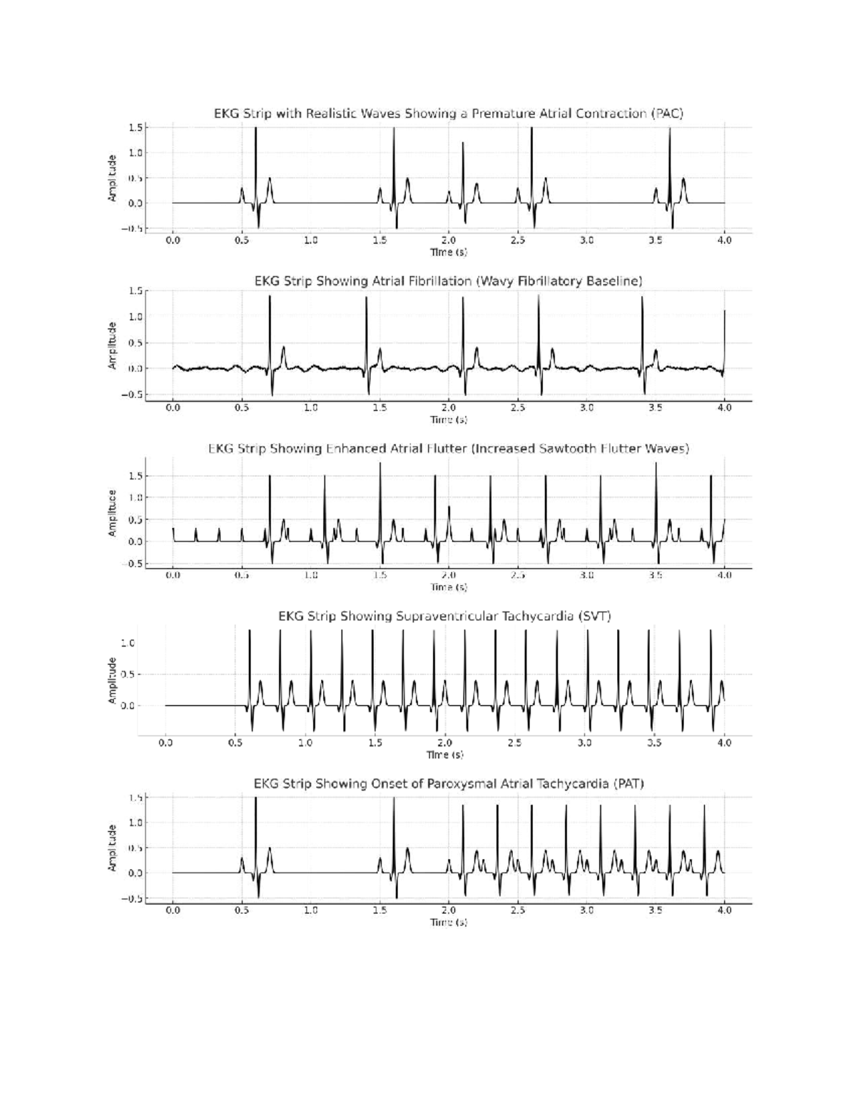 EKG Dysrhythmias Strips: PAC, Atrial Fibrillation, Flutter, SVT, PAT ...