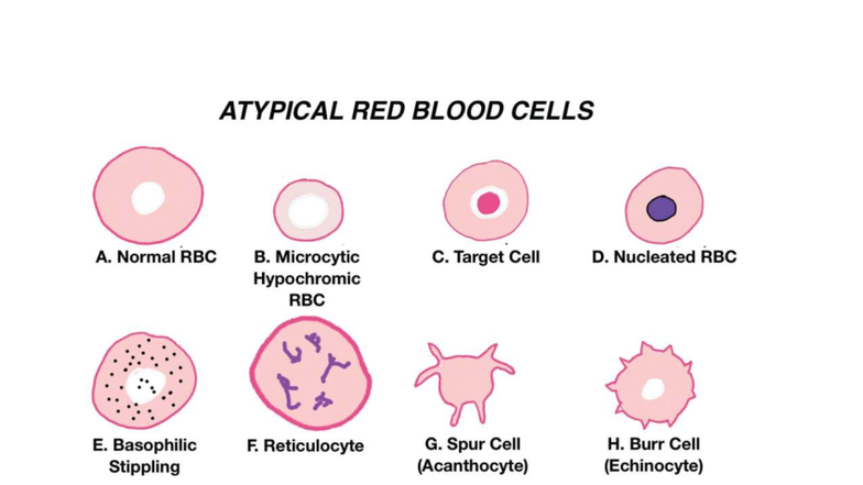Atypical RBCs Overview - Hemaa - Studocu