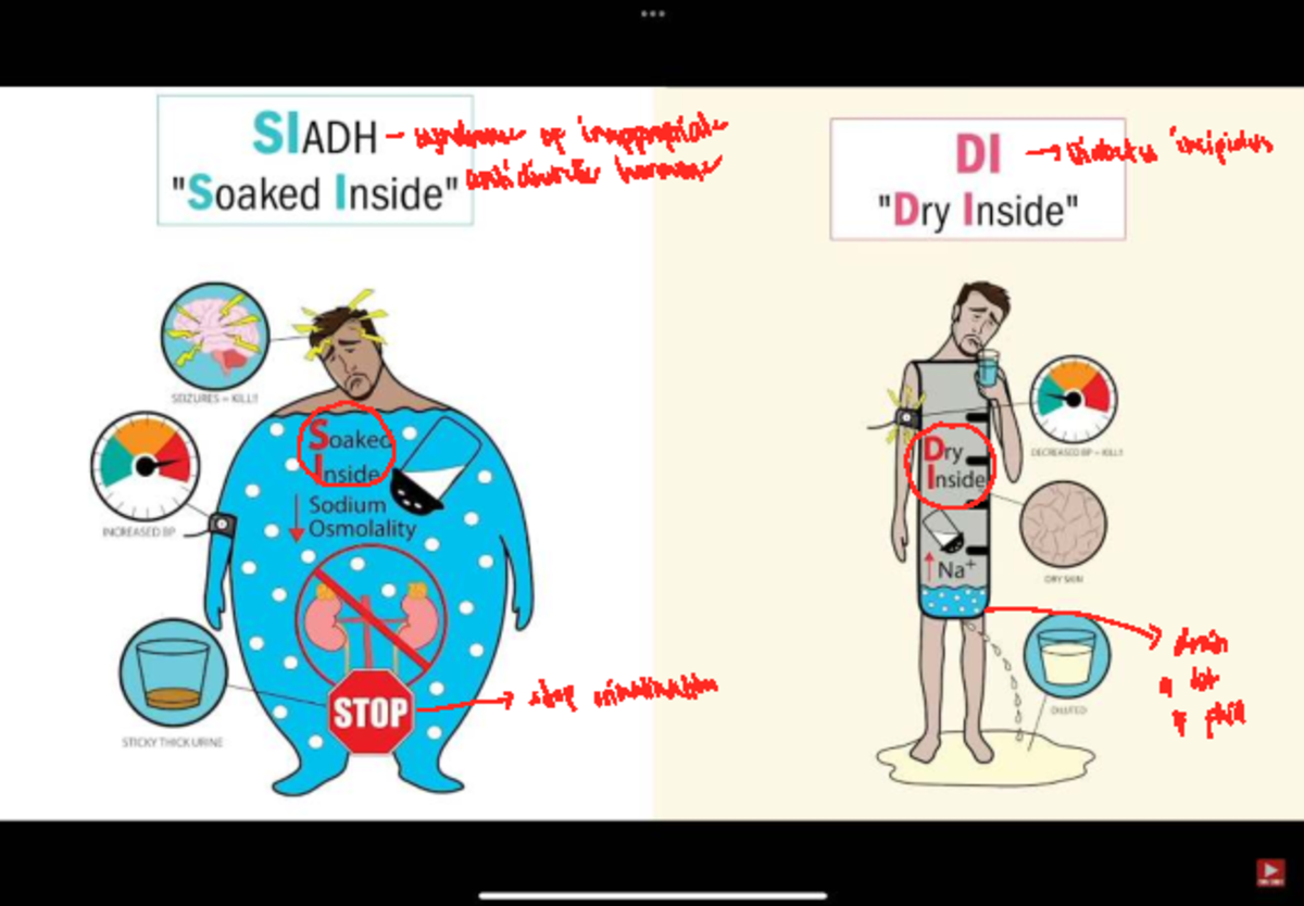 SIADH vs DI: Nursing Considerations and Interventions - Studocu
