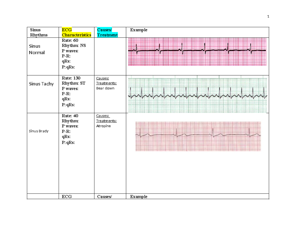 EKG - Practice EKG - Sinus Rhythms ECG Characteristics Causes ...