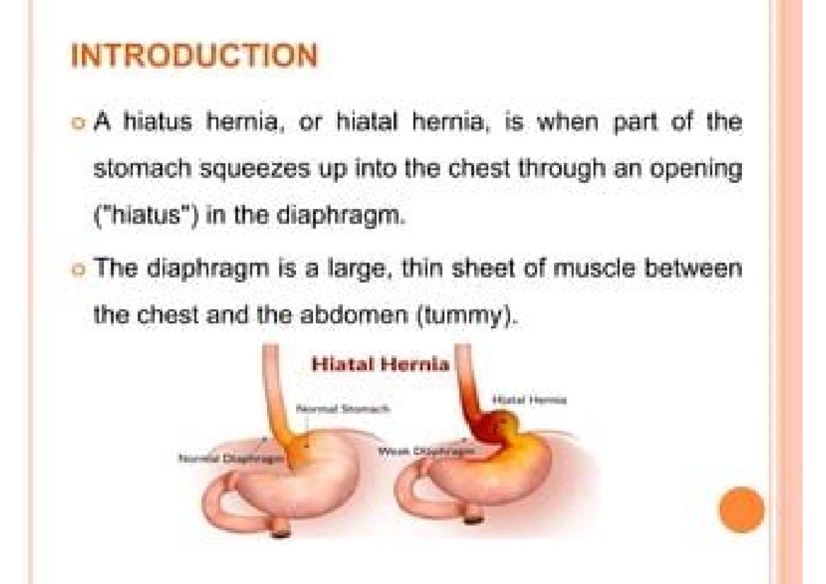 Hiatus Hernia Overview and Management - Shalya 31798 - Studocu