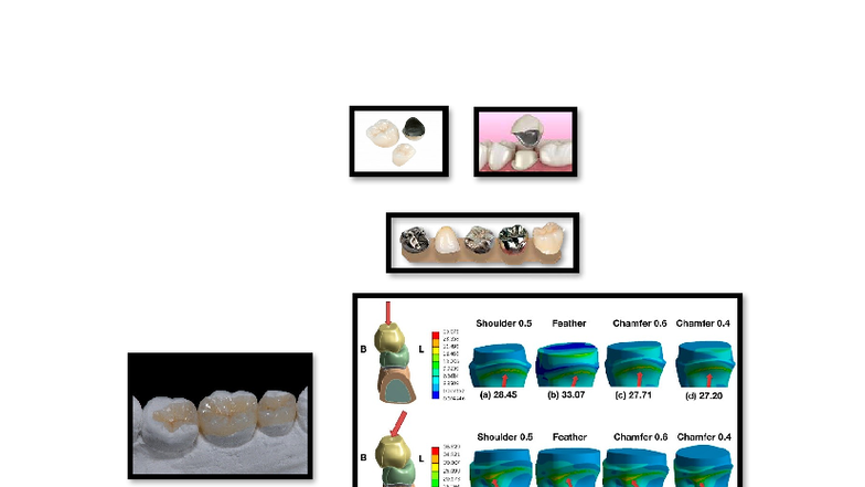 Shoulder and Chamfer Preparation Techniques for Dental Restorations ...