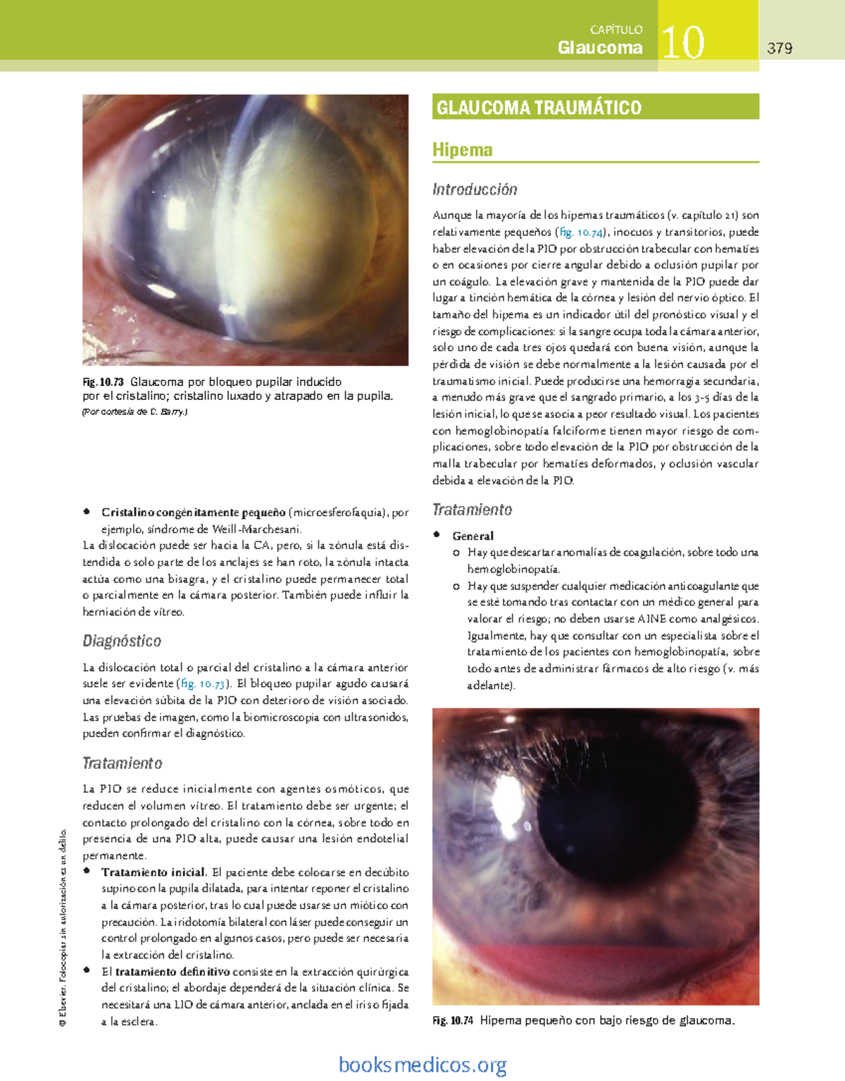 CAPÍTULO 10: Glaucoma Traumático y Hipema - Introducción y Tratamiento ...
