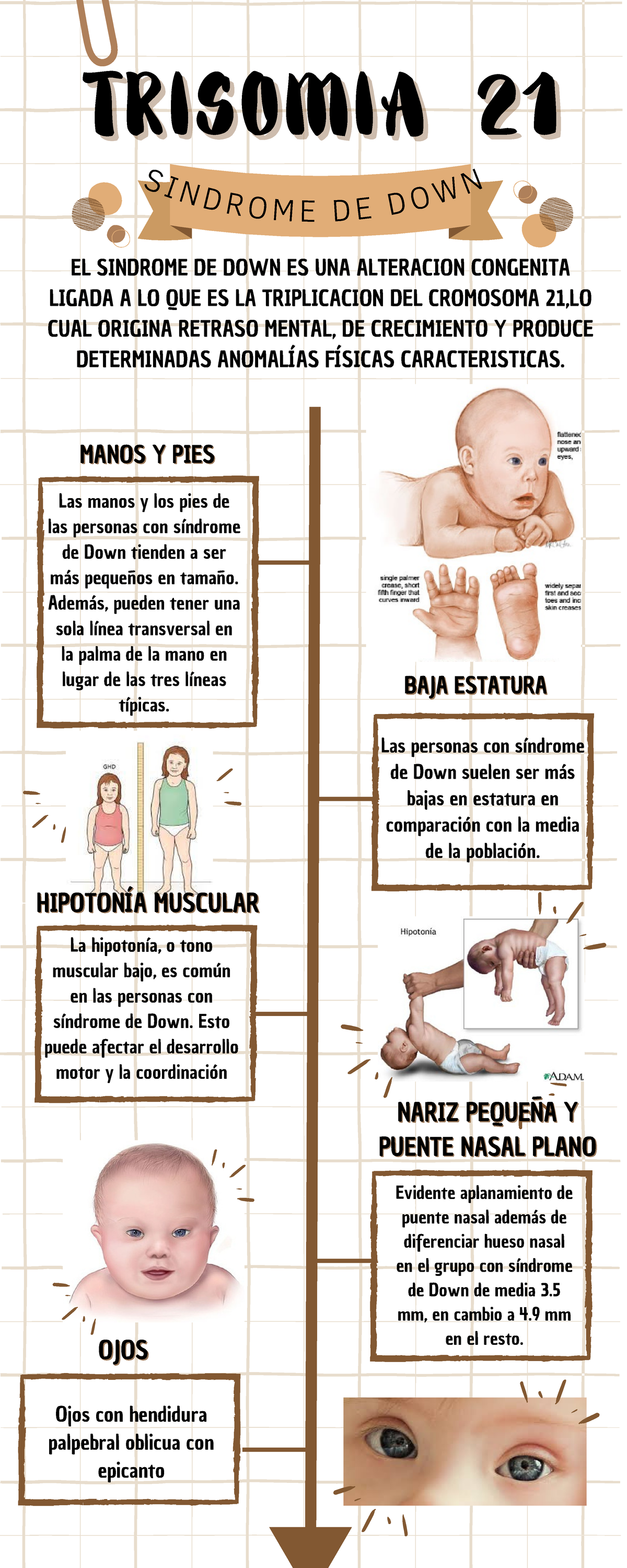 Infografía de trisomía 21 - OJOSOJOS TRISOMIA 21 TRISOMIA 21 S I N D R ...