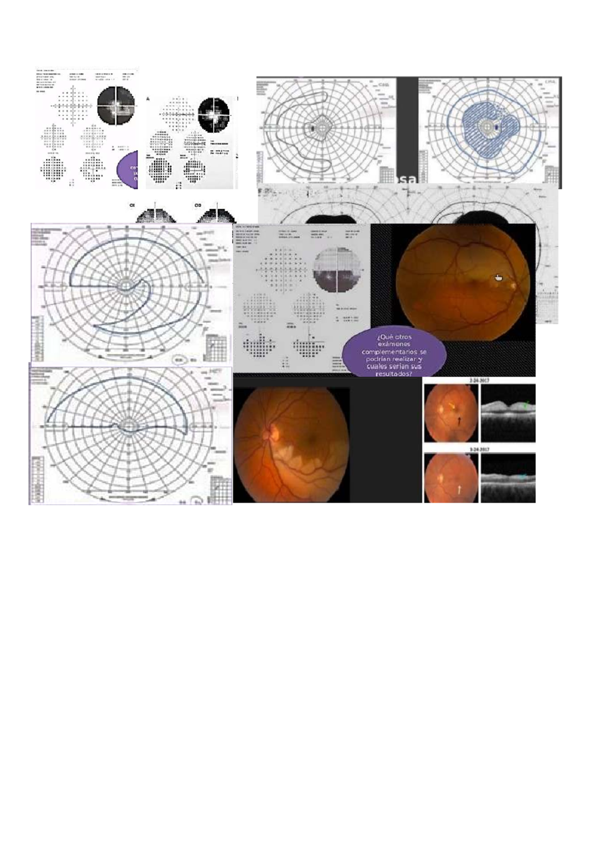 Retinitis Pigmentosa y Oclusiones Arteriales: Estudio Completo - Studocu