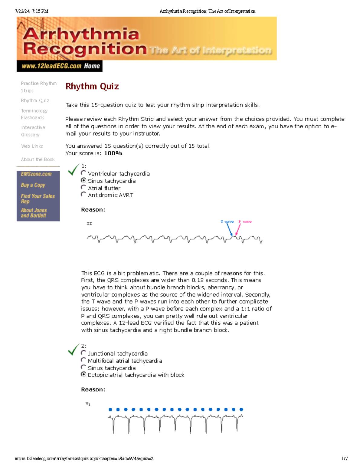 Rhythm Interpretation Quiz for Arrhythmias: Test Your Skills - Studocu