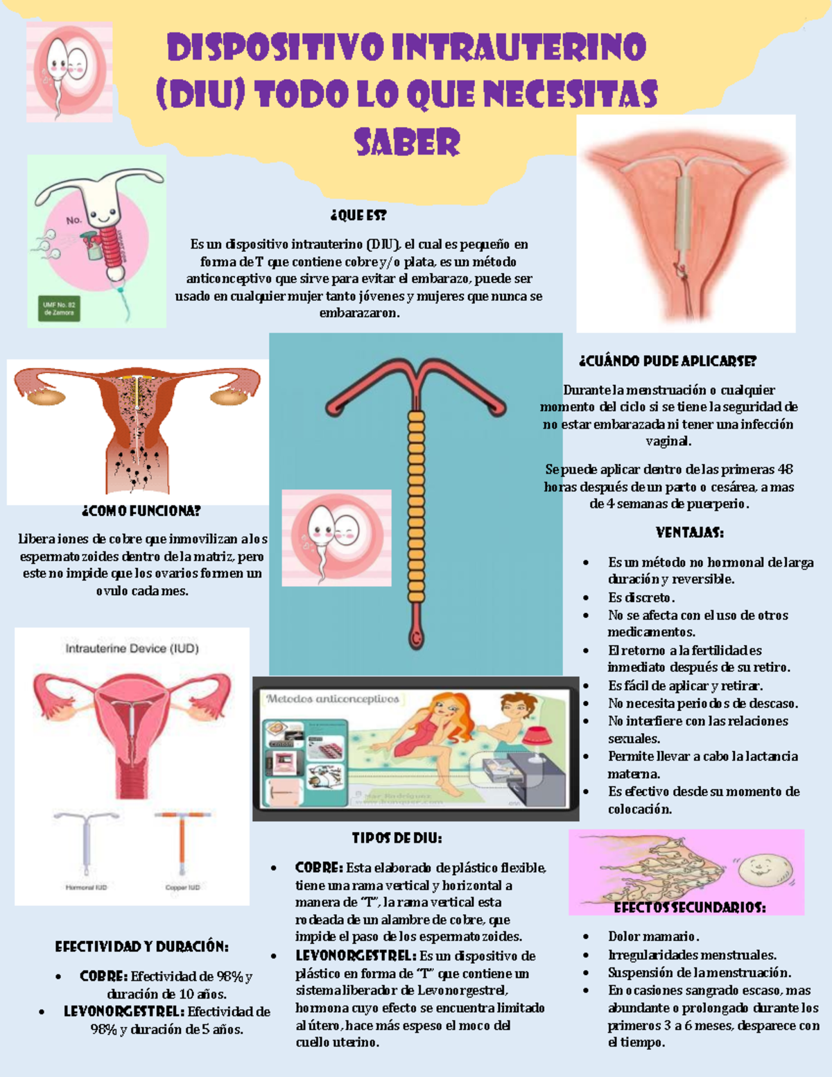 infografía sobre el DIU (dispositivo intrauterino) - Medicina ...