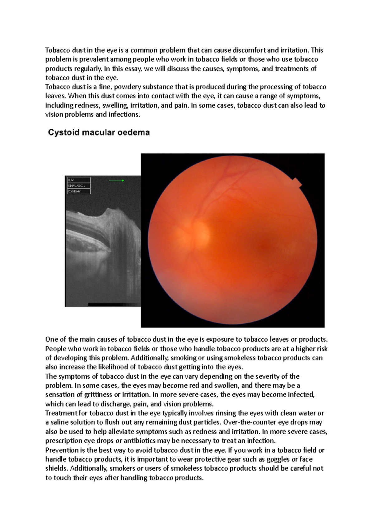 Effects and Treatments of Tobacco Dust in the Eye: A Study - Studocu
