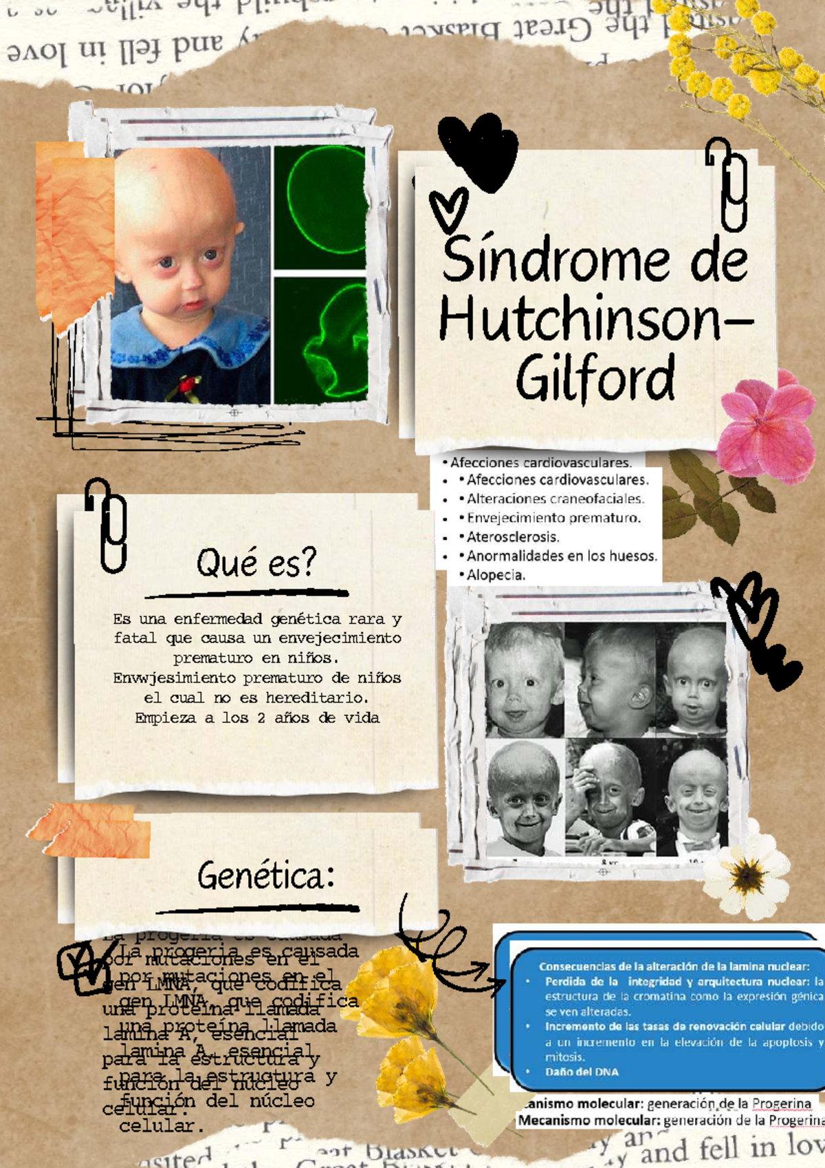 Síndrome de Hutchinson-Gilford: Entendiendo la Progeria - Studocu