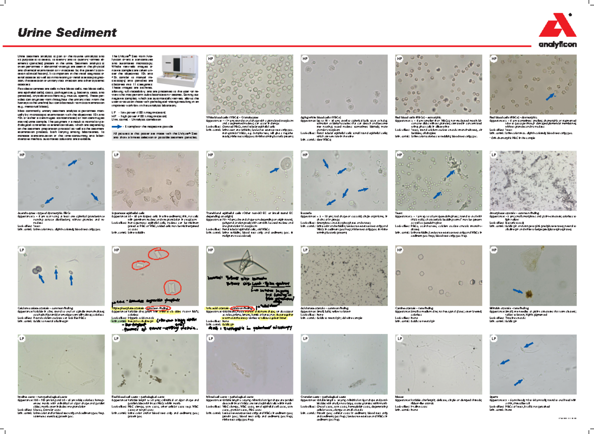 Urinalysis-artifacts - Urine Sediment Calcium oxalate crystals – common ...