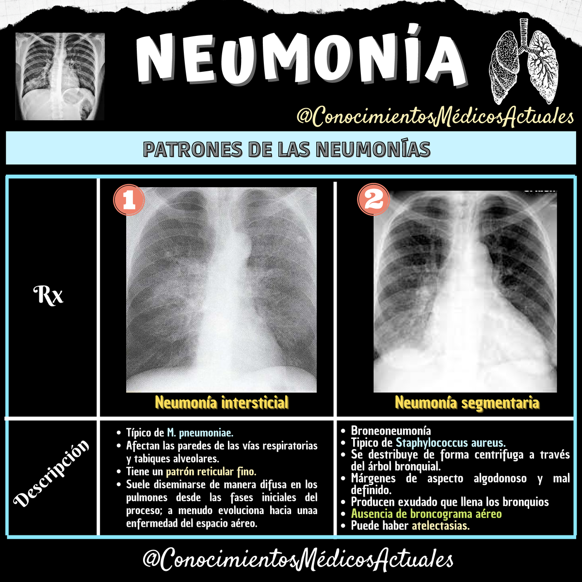 Patrones Radiográficos de Neumonía: Estudio Detallado - Studocu