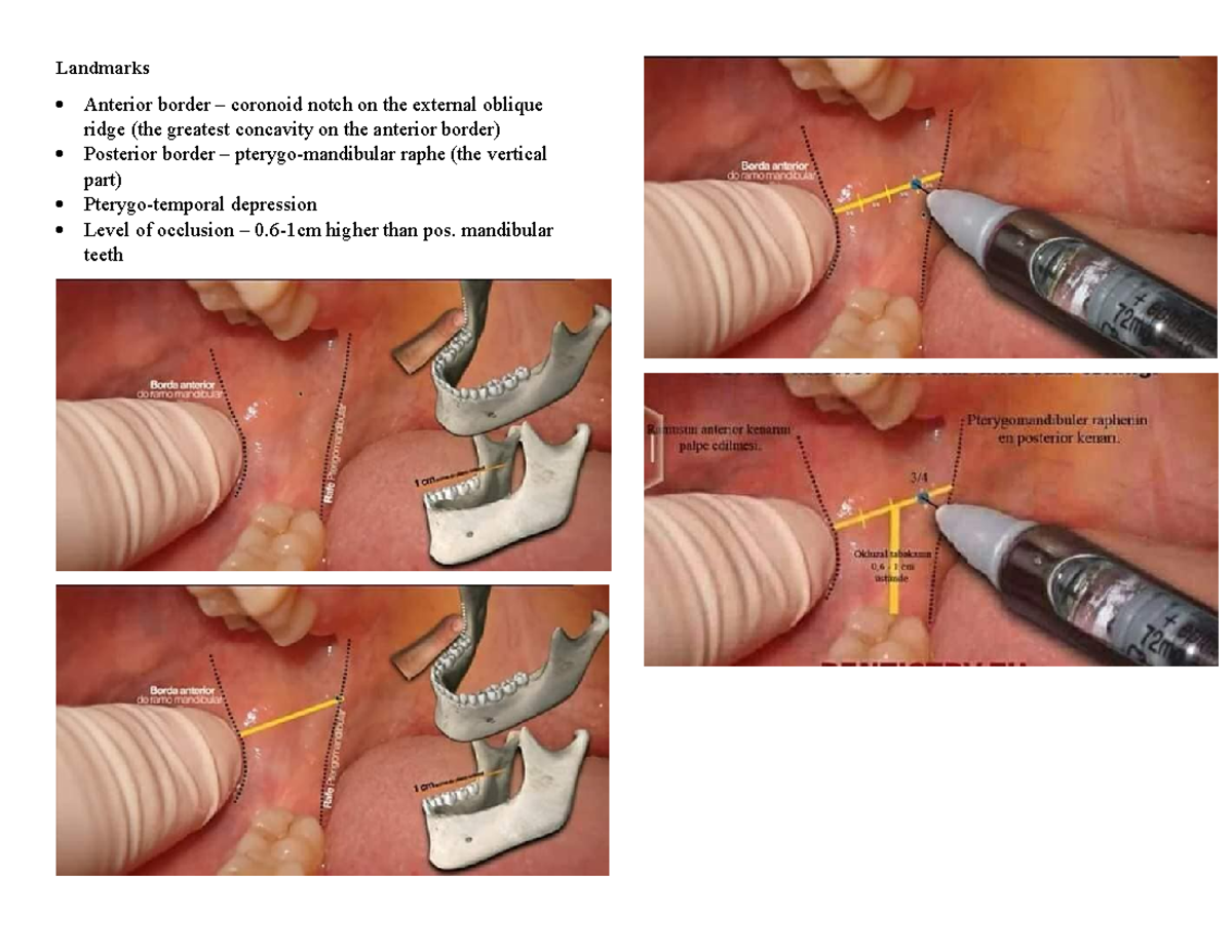 IANB Technique and Considerations: Landmarks & Anesthesia Overview ...