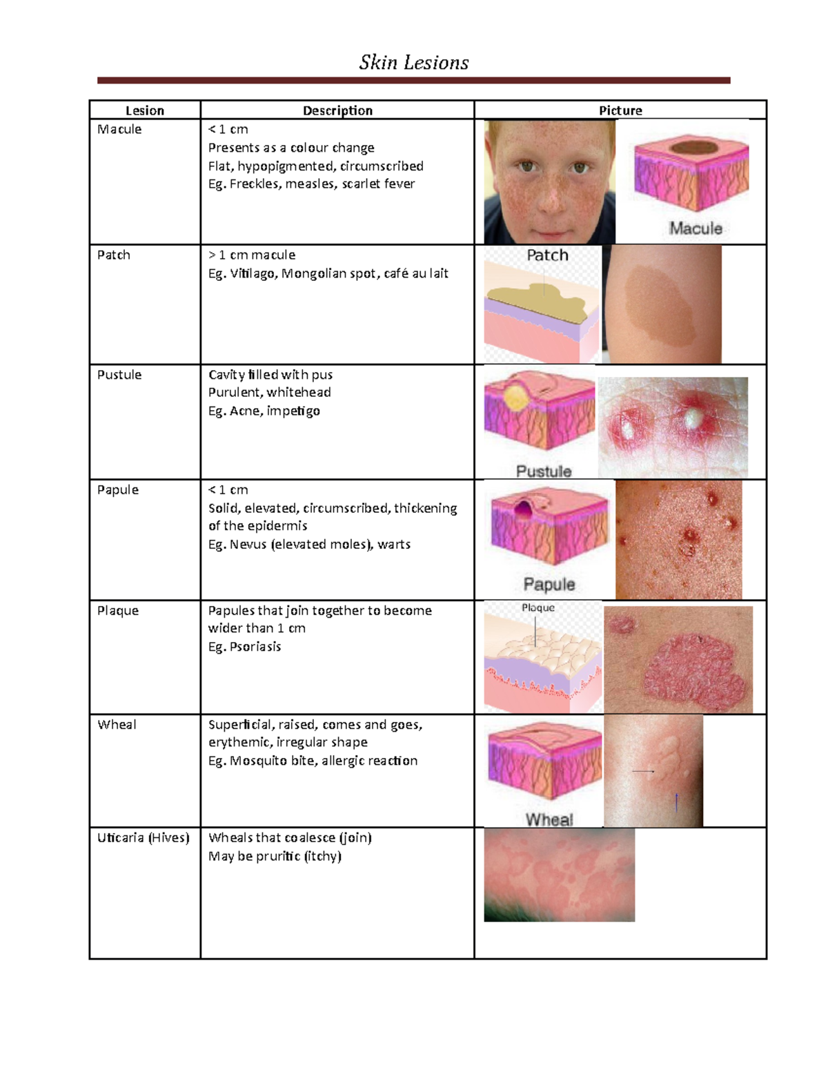 Summary of Skin Lesions - Skin Lesions Lesion Description Picture Macule