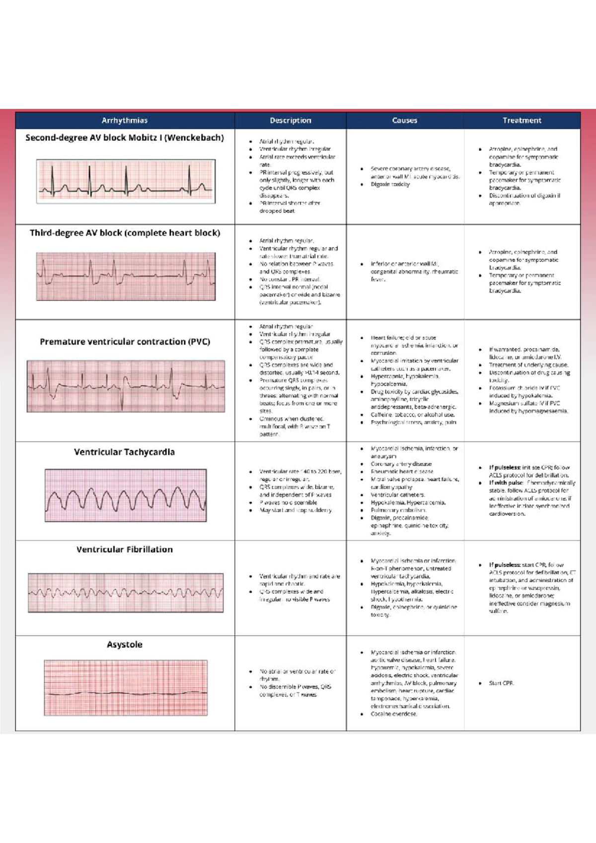 ECG - EKG - Arrhythmias Description Causes Treatment AV block Mobitz I ...