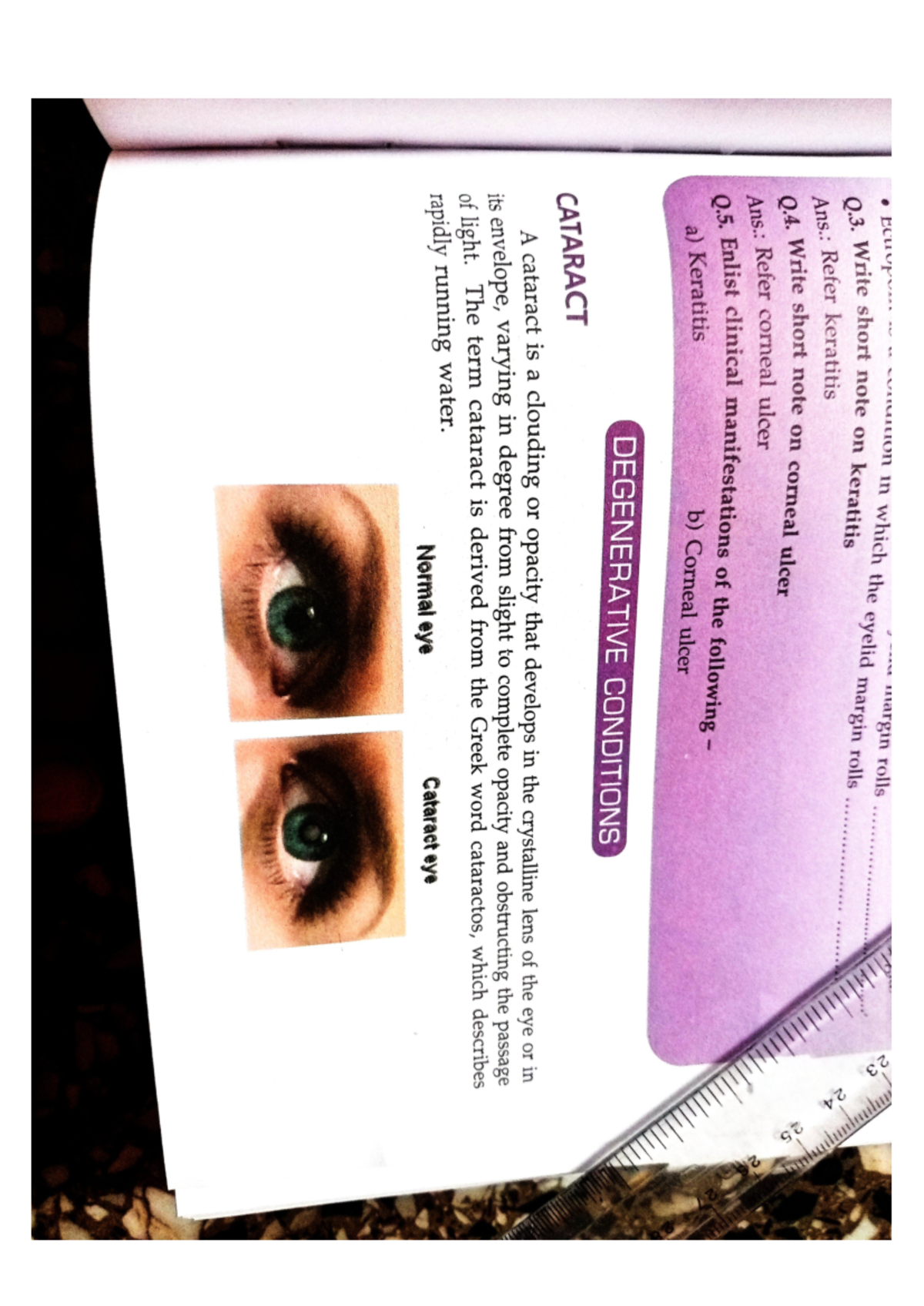 Cataract introduction - B.Sc. Nursing - Studocu