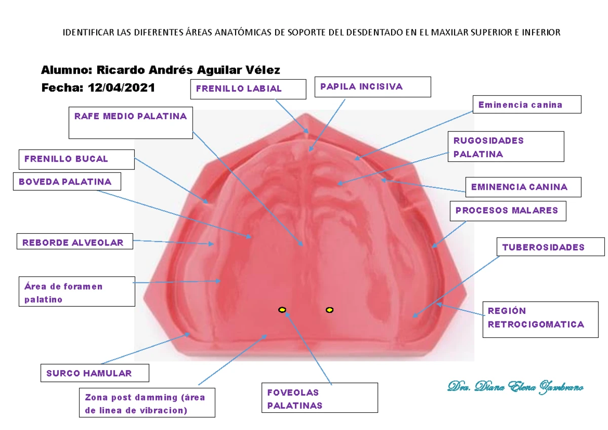 Rodetes DE CERA Protesis Removible Grupo # 3 - UNIVERSIDAD DE GUAYAQUIL ...