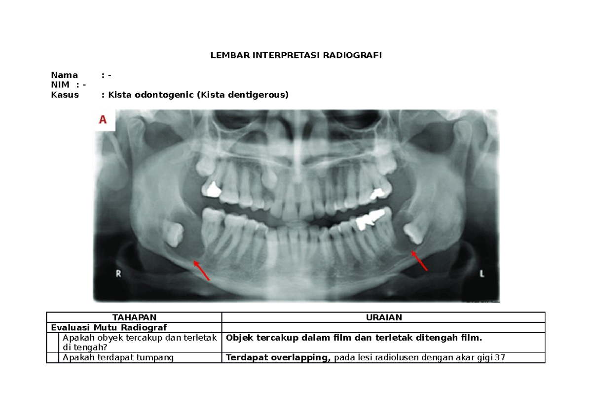 Interpretasi Radiografi Kista Odontogenik pada Gigi 37 dan 38 - Studocu