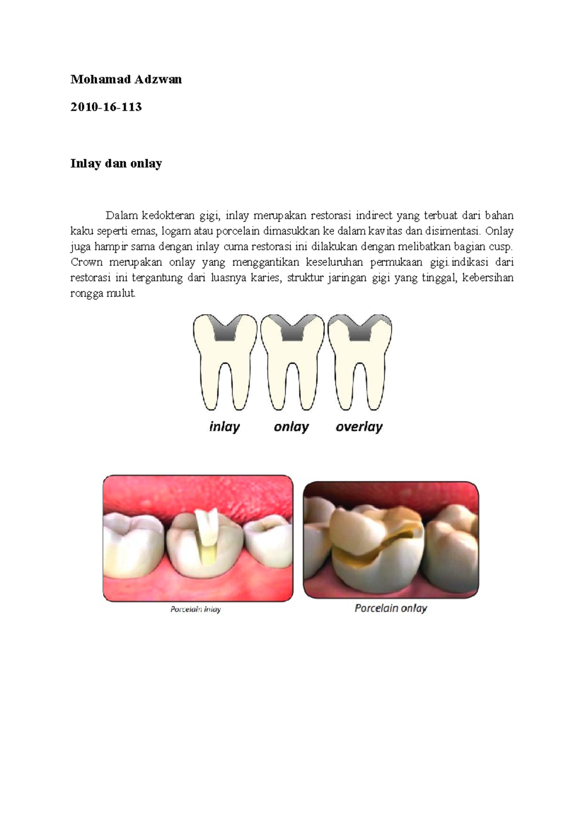 61586944 Inlay Dan Onlay - Mohamad Adzwan 2010-16- Inlay dan onlay ...