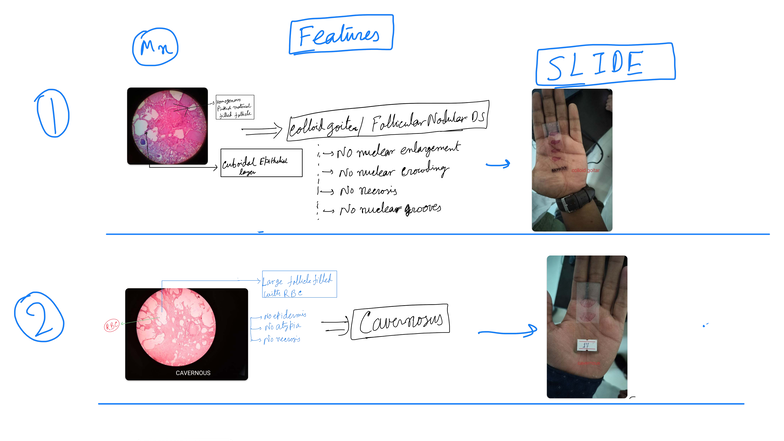 Histopathology Features Mn SLIDE: Colloid Nodular Goiter & Vascular ...