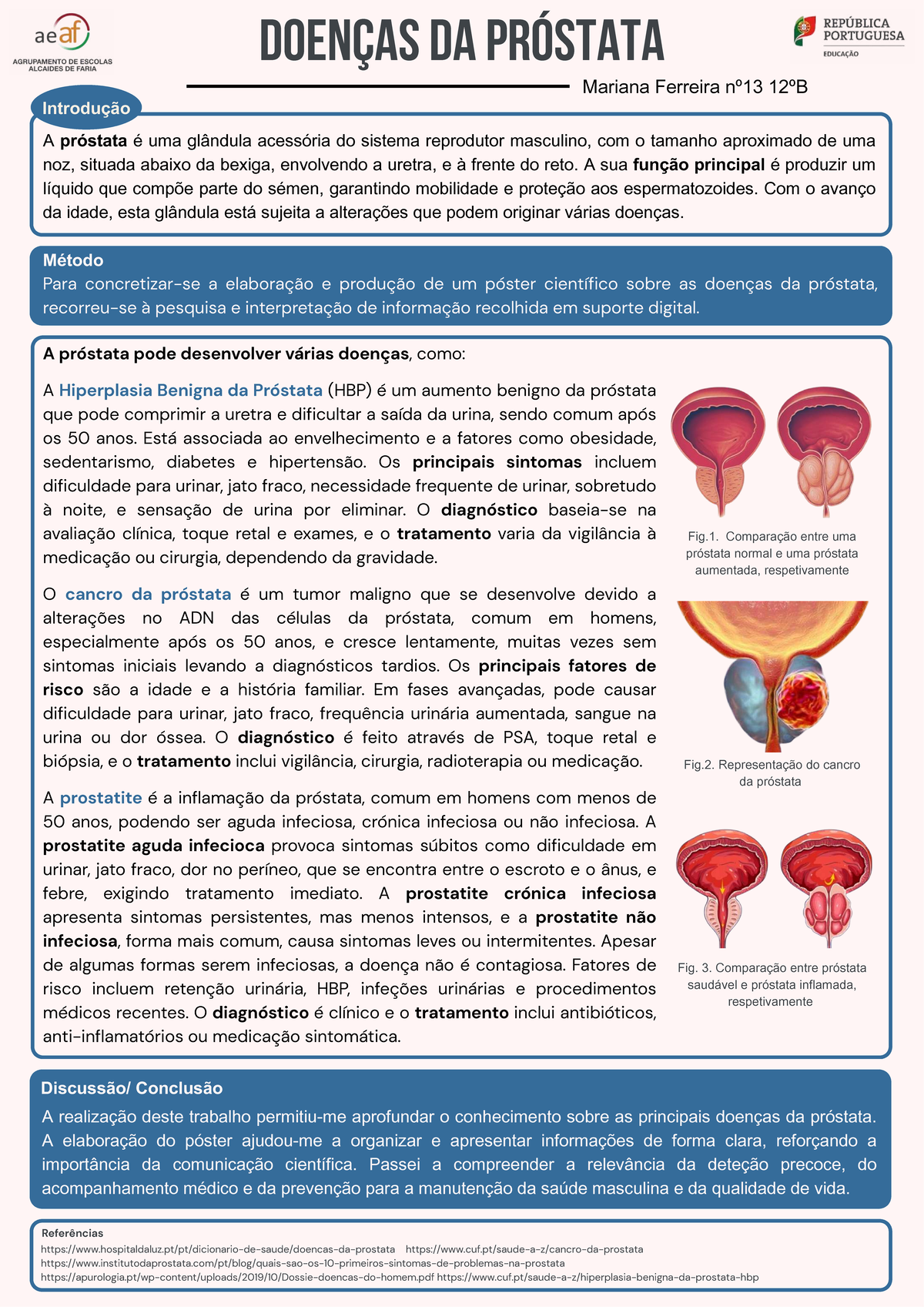 Doenças da Próstata: Trabalho de Biologia 12ºB - Mariana Ferreira - Studocu