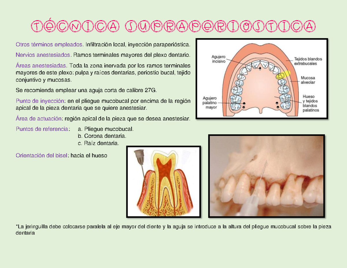 Técnica Supraperiostica de Anestesia Dental: Instrucciones y ...
