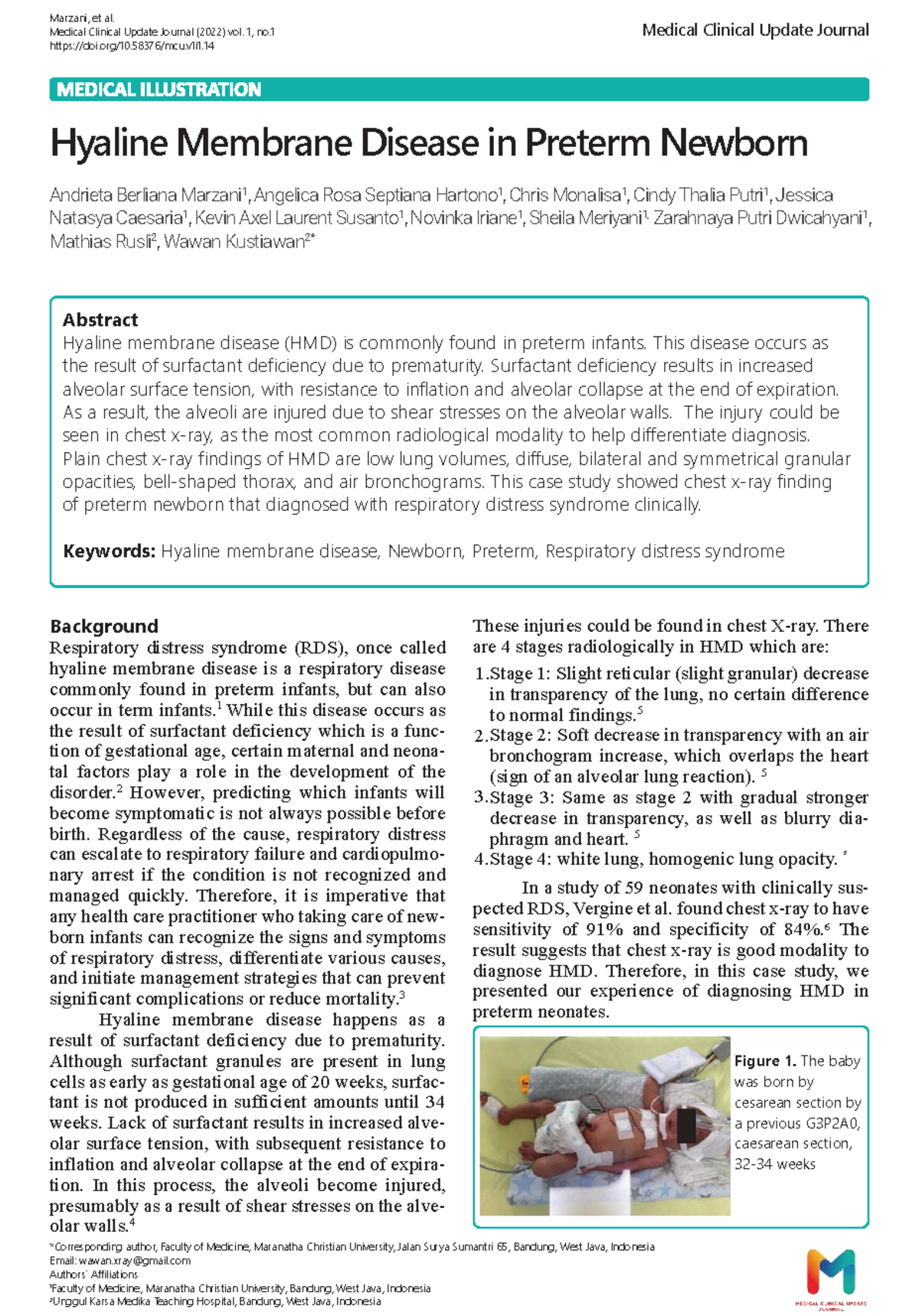 Hyaline membrane disease in preterm newborns: A case study analysis ...