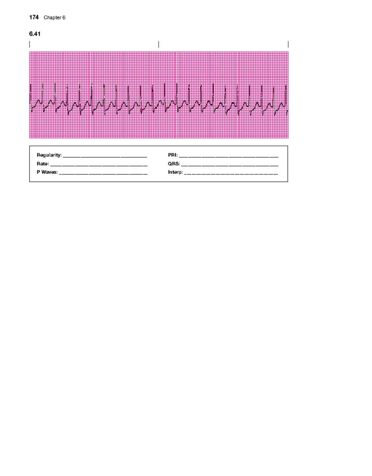 174 EKG Analysis Guide: Heart Blocks Overview and Interpretation - Studocu