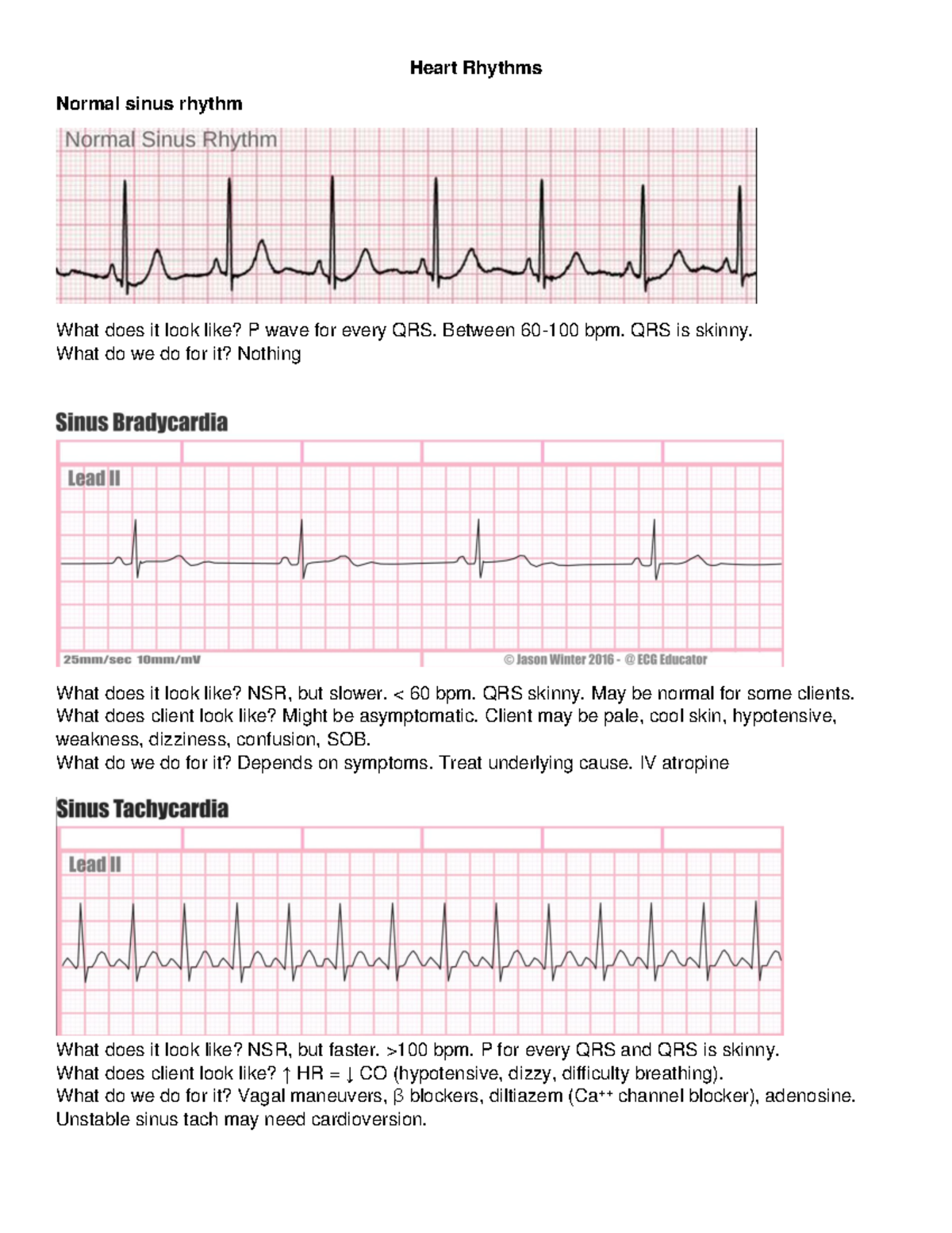 Dysrhythmias cheat sheet - Heart Rhythms Normal sinus rhythm What does ...