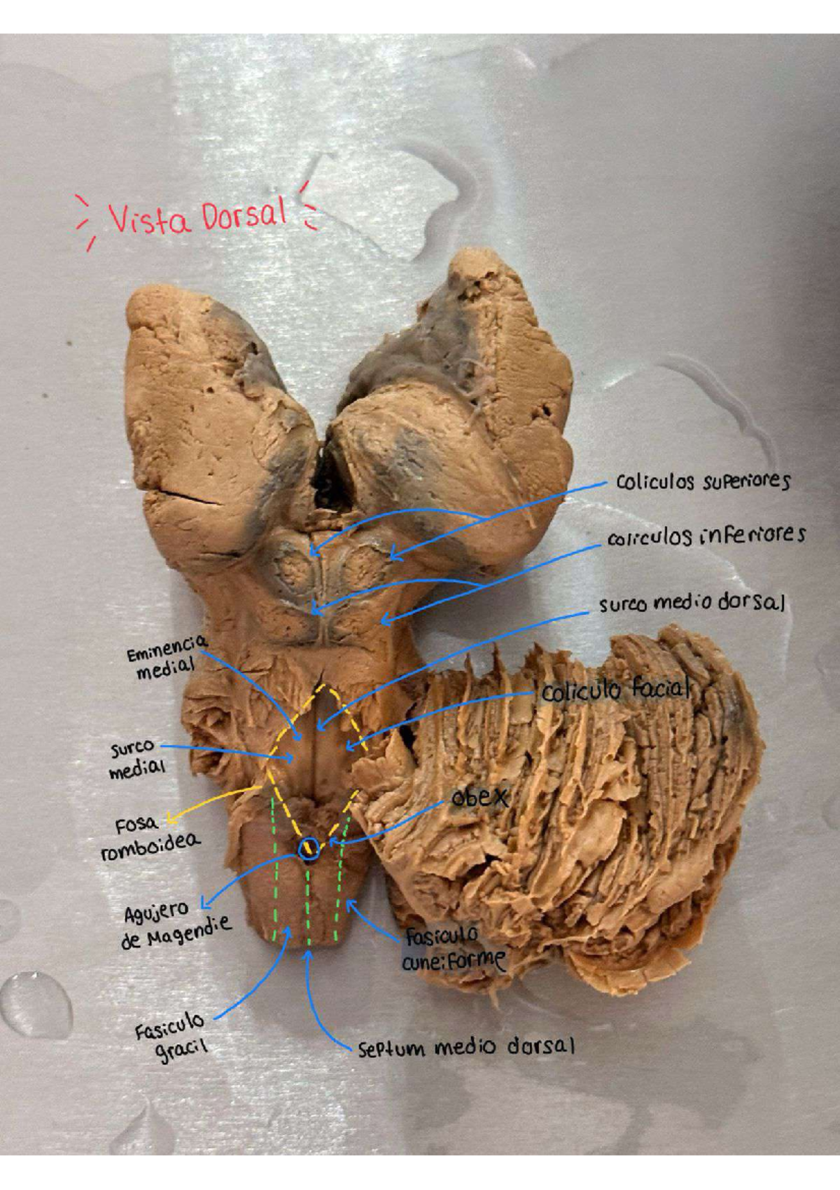 Tallo y corte coronal - Neuroanatomía - Vista Dorsal coliculos ...