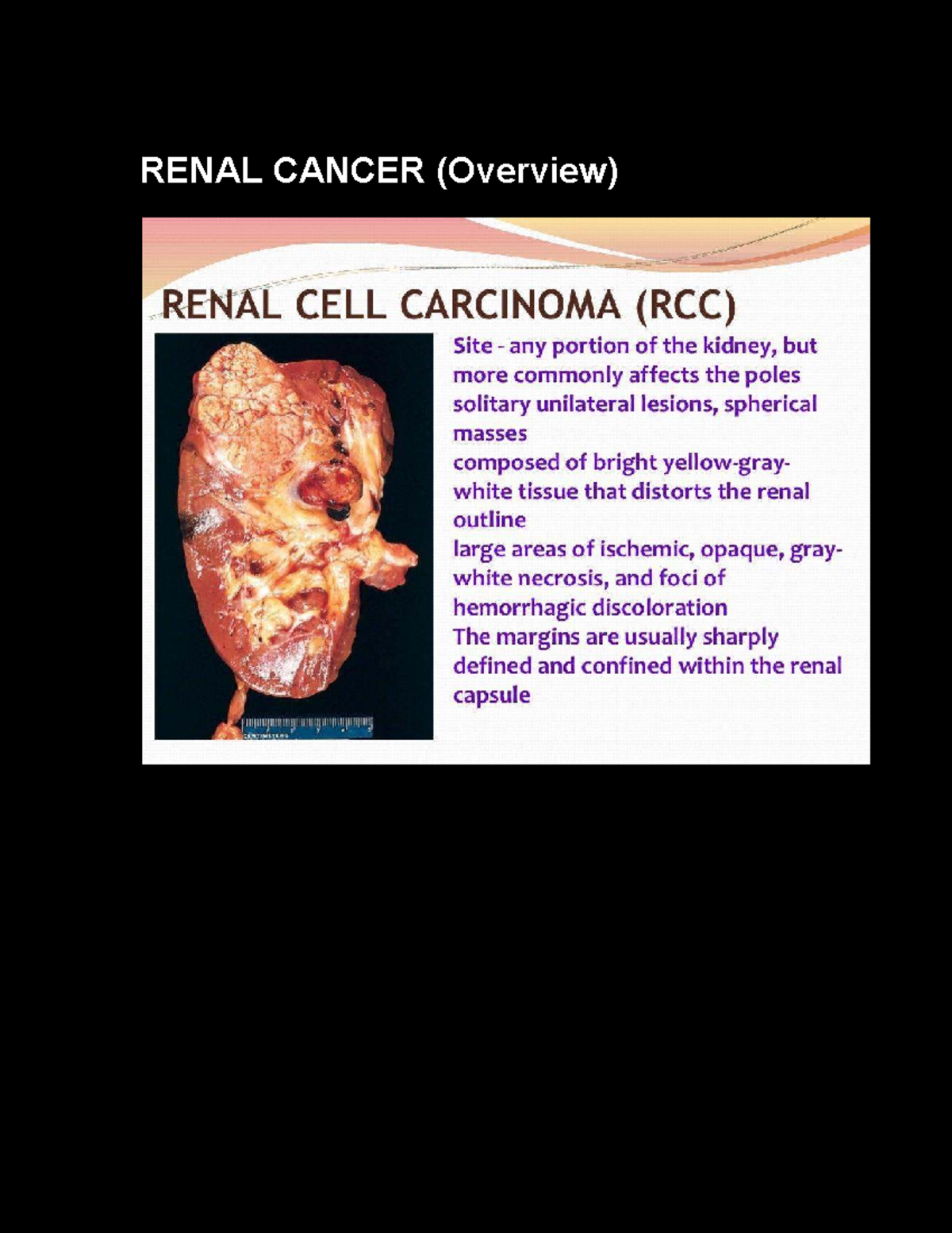 RENAL CANCER Overview & Key Points for Exam (NURS 101) - Studocu