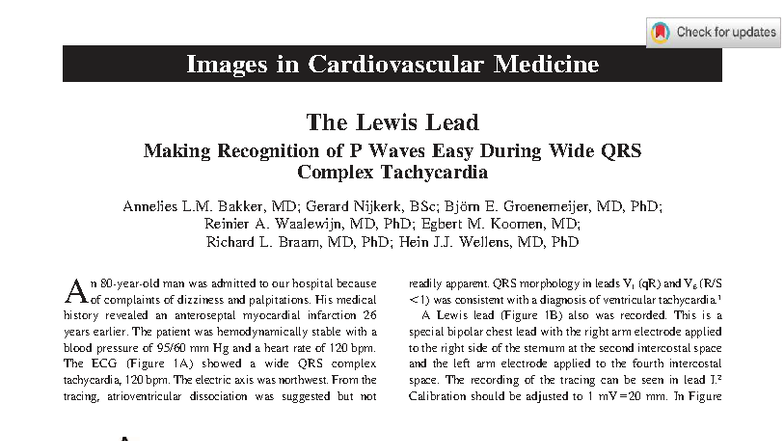 The Lewis Lead in Cardiovascular Medicine: Recognizing P Waves in Wide ...