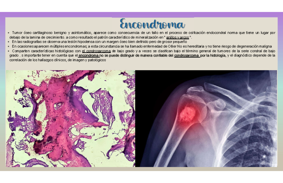 5. Encondroma - Descripcion de patologias radiologicas. - Encondroma ...