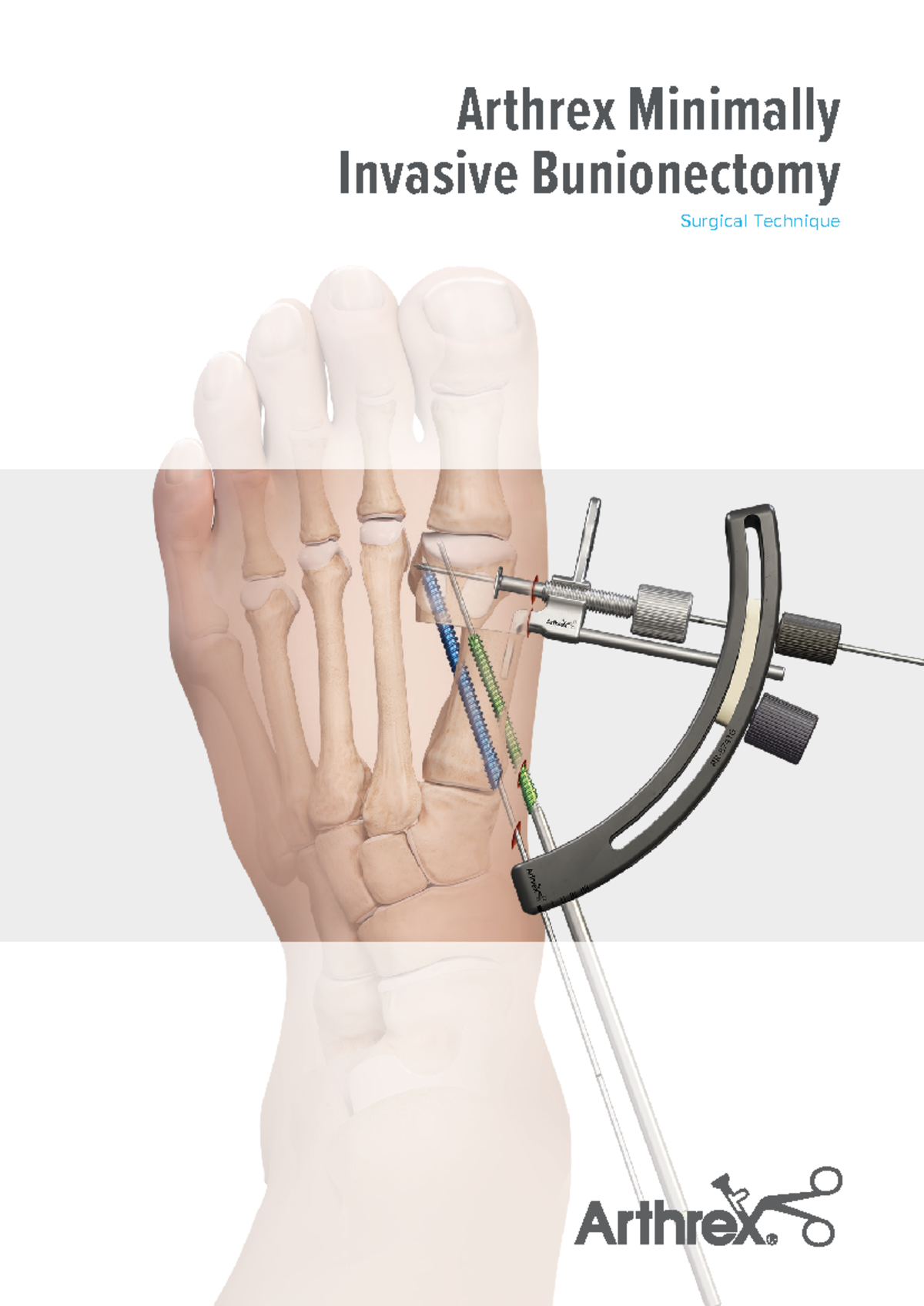 Arthrex minimally invasive bunionectomy - Arthrex Minimally Invasive ...