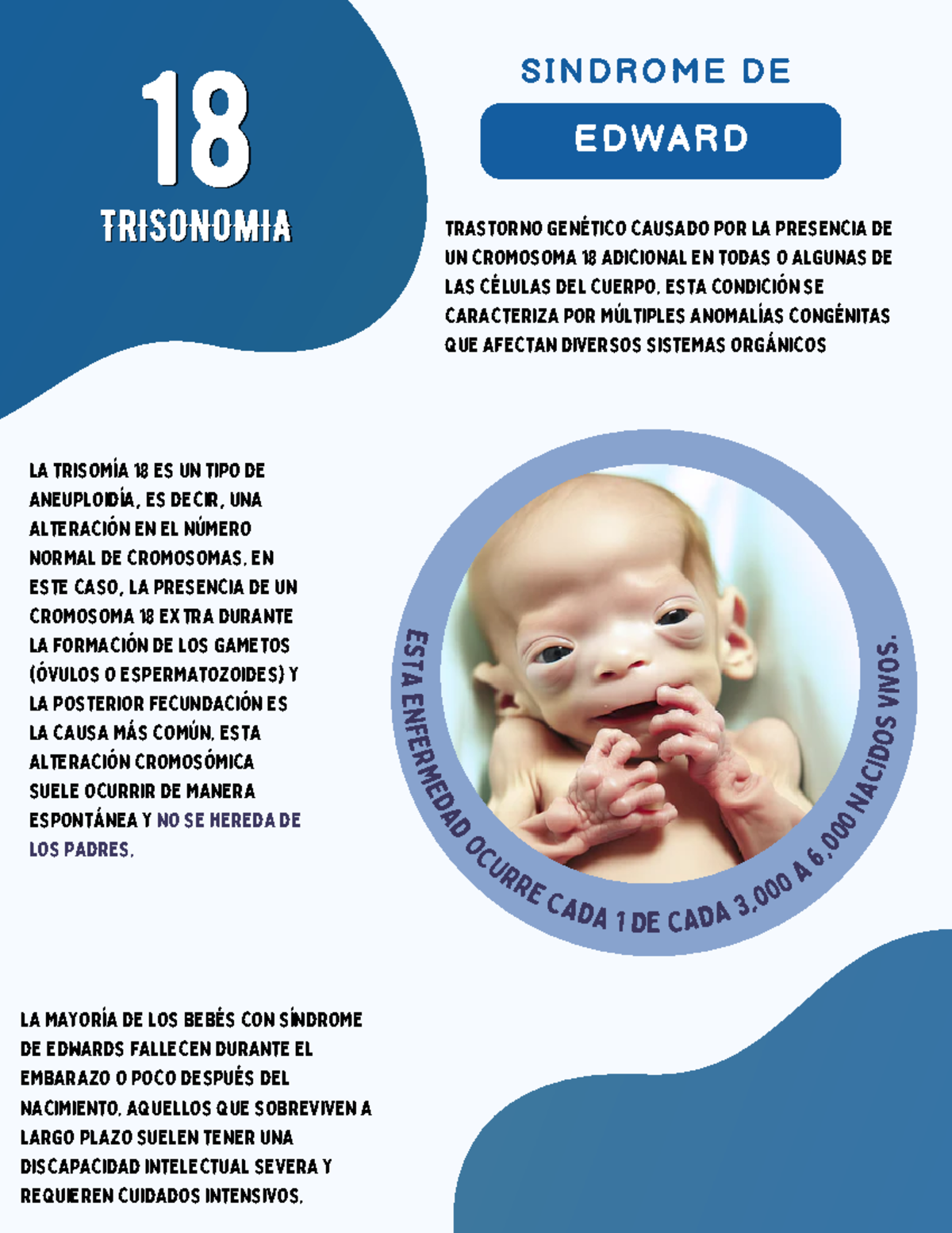 Sindrome de Edwards: Trisomía 18 y sus Implicaciones Genéticas - Studocu