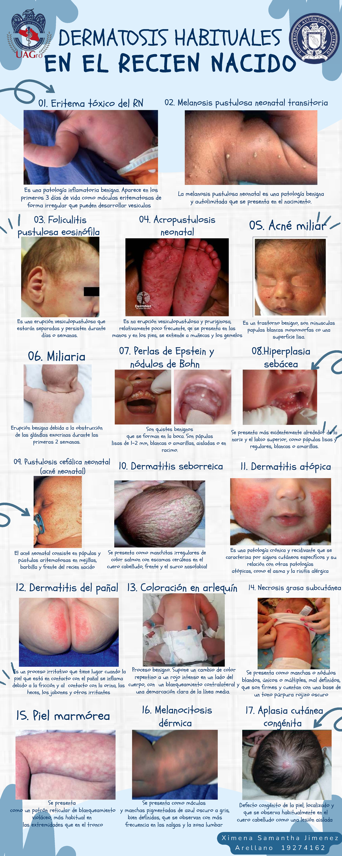Melanose Pustulosa Neonatal Transitoria Título: Melanosis Pustulosa