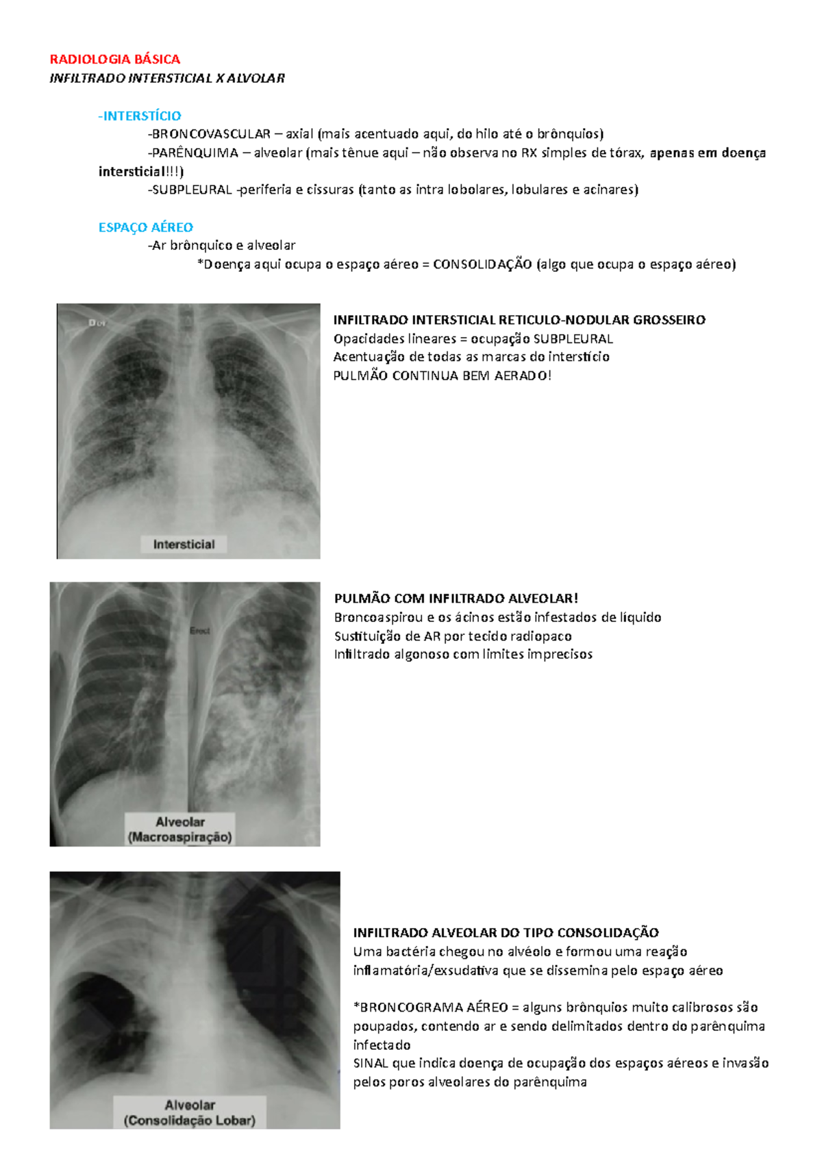 Radiologia Básica: Infiltrado Intersticial e Alveolar Análise - Studocu