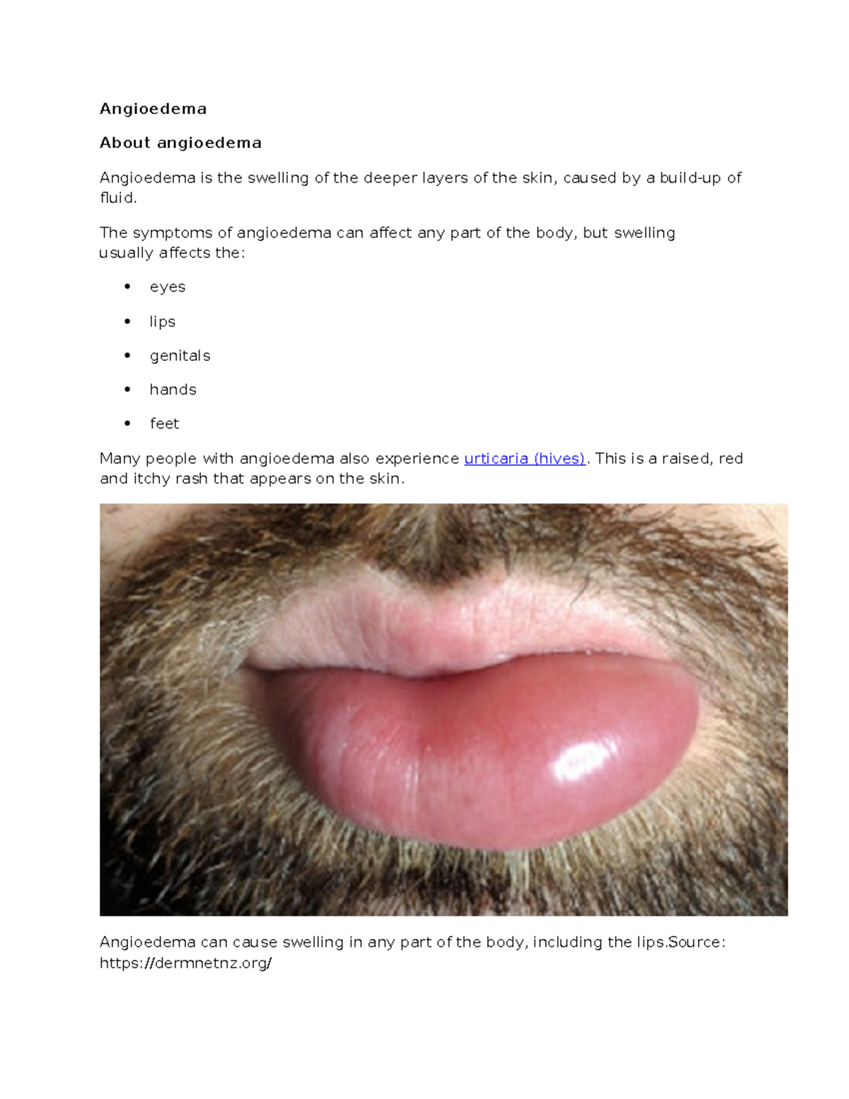 Angioedema - illnesses and conditions - Angioedema About angioedema ...