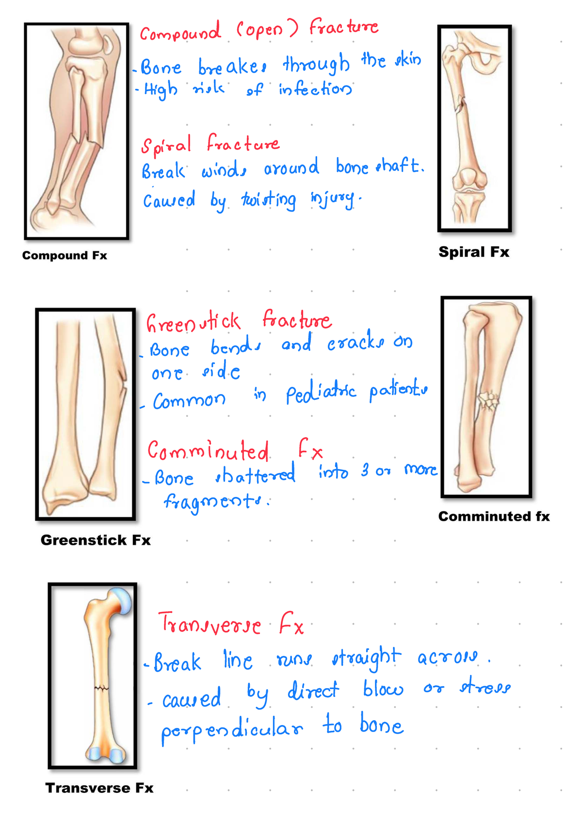 Fracture Types and Mechanisms: A Comprehensive Overview (MED 101) - Studocu