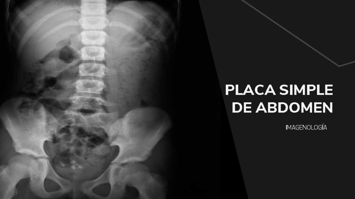 Rx Simple de Abdomen: Proyecciones y Evaluación Clínica - Studocu