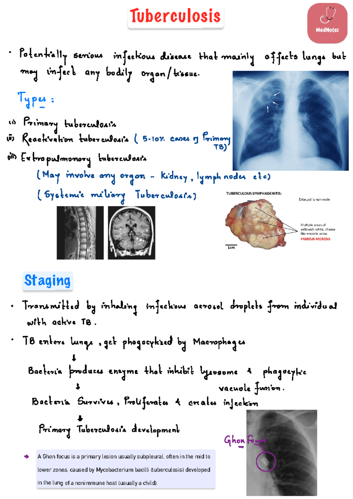 6. Tuberculosis - Tuberculosis Staging A Ghon focus is a primary lesion ...