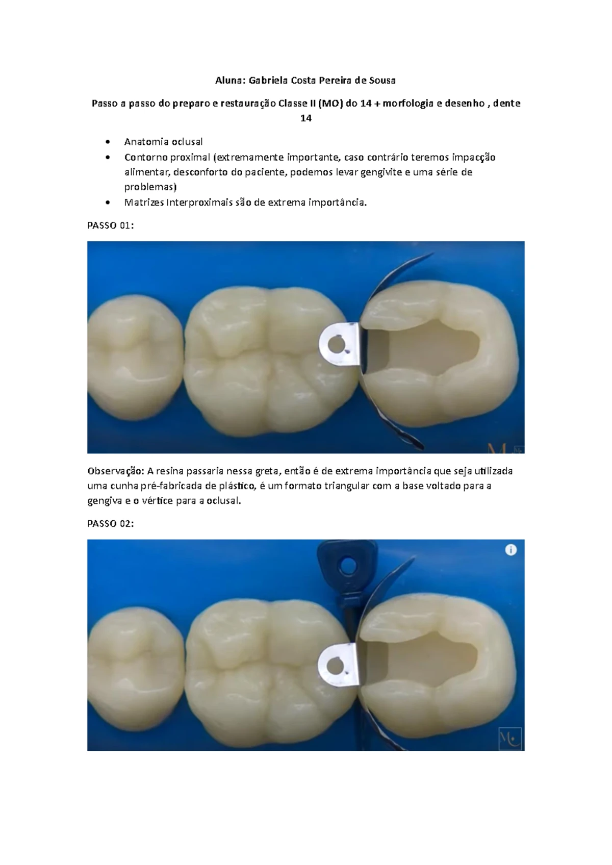 Preparação e Restauração Classe II MOD do Dente 26: Guia Completo - Studocu
