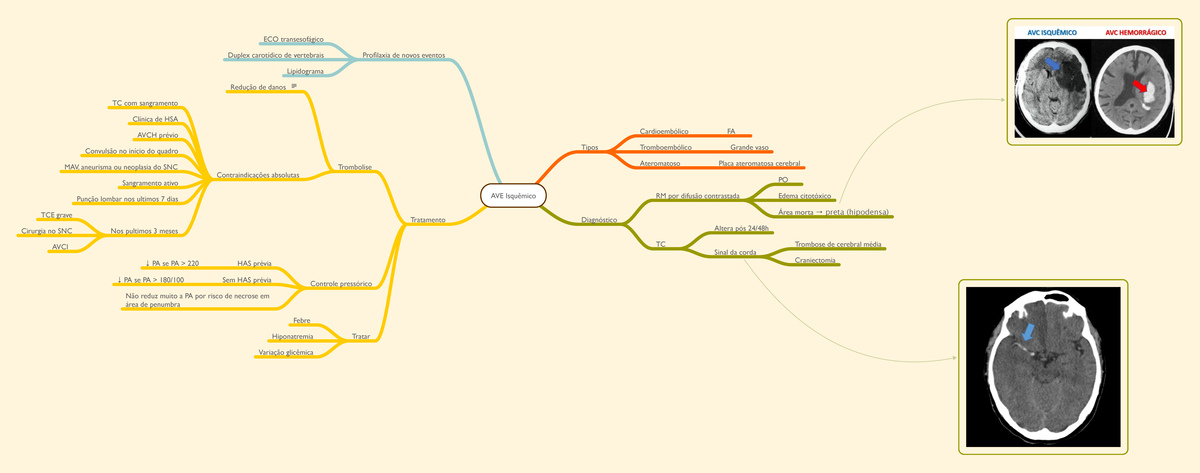 AVE Isquêmico - Mapa mental de urgência. - ECO Duplex de vertebrais ...