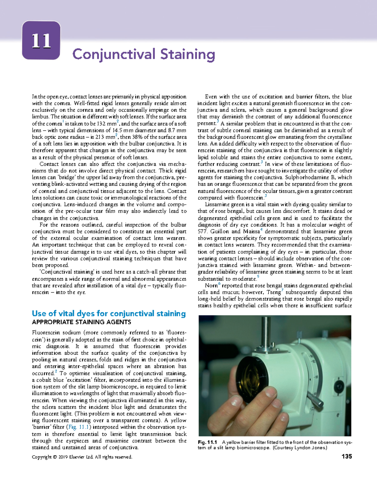 Conjunctival Staining Contact Lens Complications - 1111 Conjunctival ...