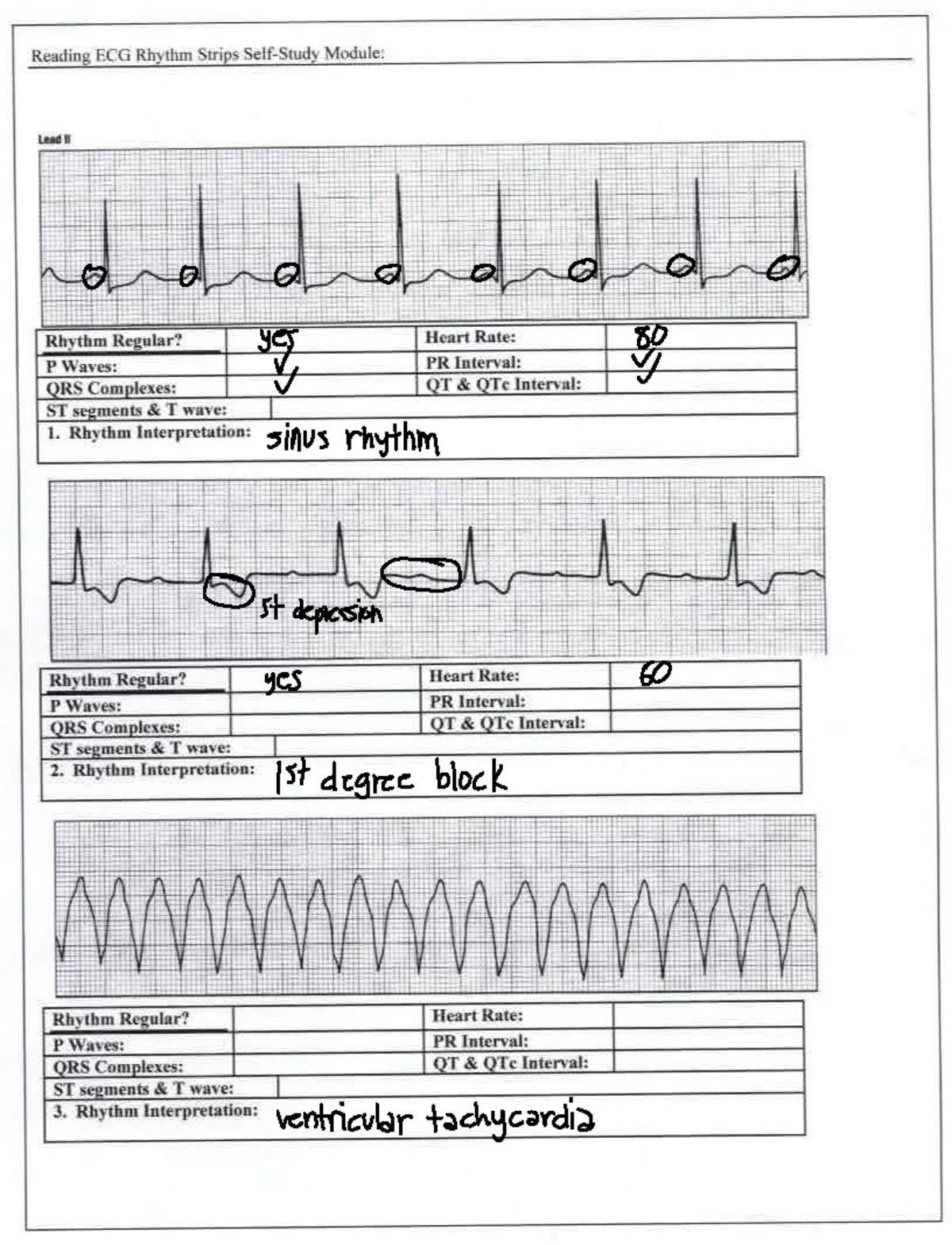 EKG Practice: Rhythm Analysis & Arrhythmia Overview - Studocu